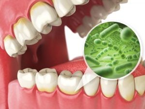 What is Dental Plaque, and How Can I Get Rid of It?