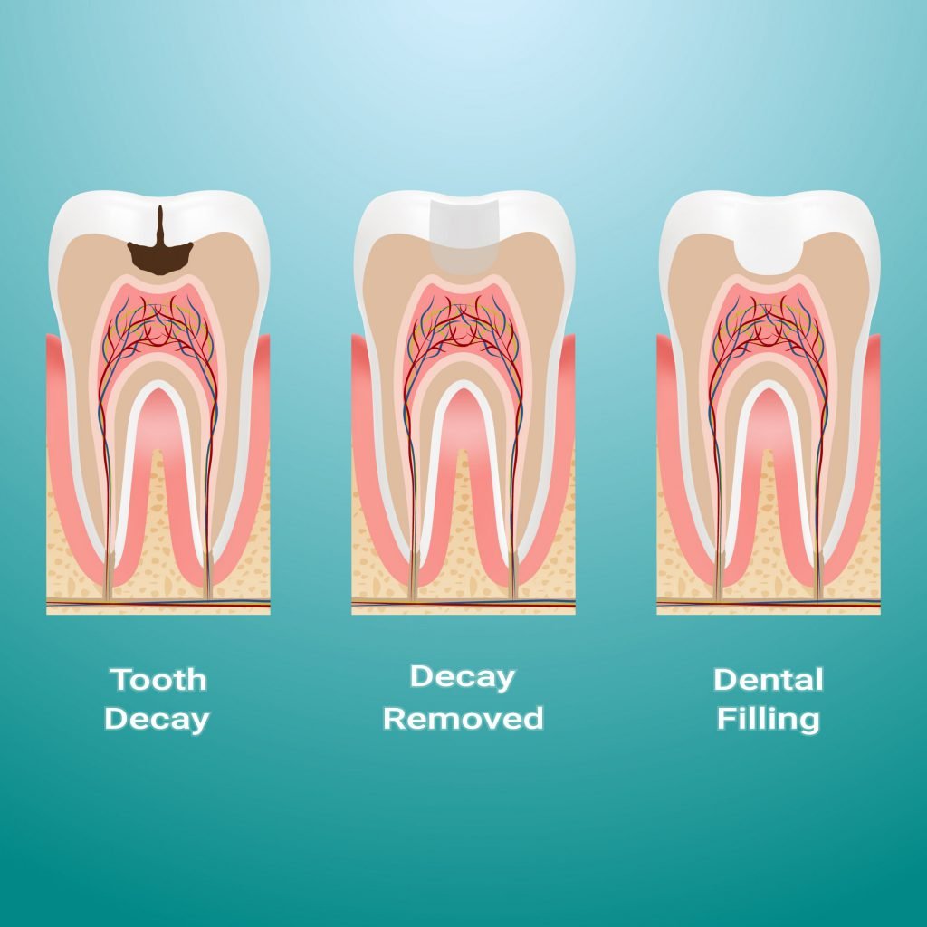 How Do Fillings Work?