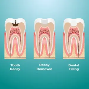 How Do Fillings Work?
