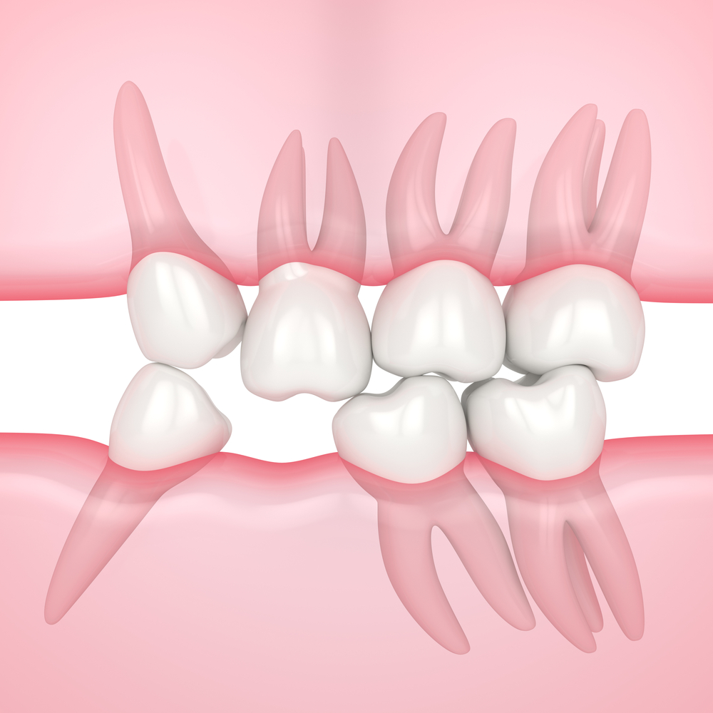 Why Replacing Lost Teeth is Important